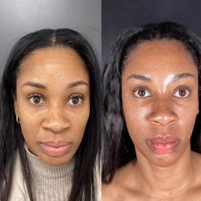 Before & After Photos | Atlanta, GA | SkinCeuticals SkinLab Atlanta